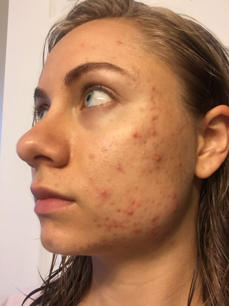 My Skin Story - Part 1