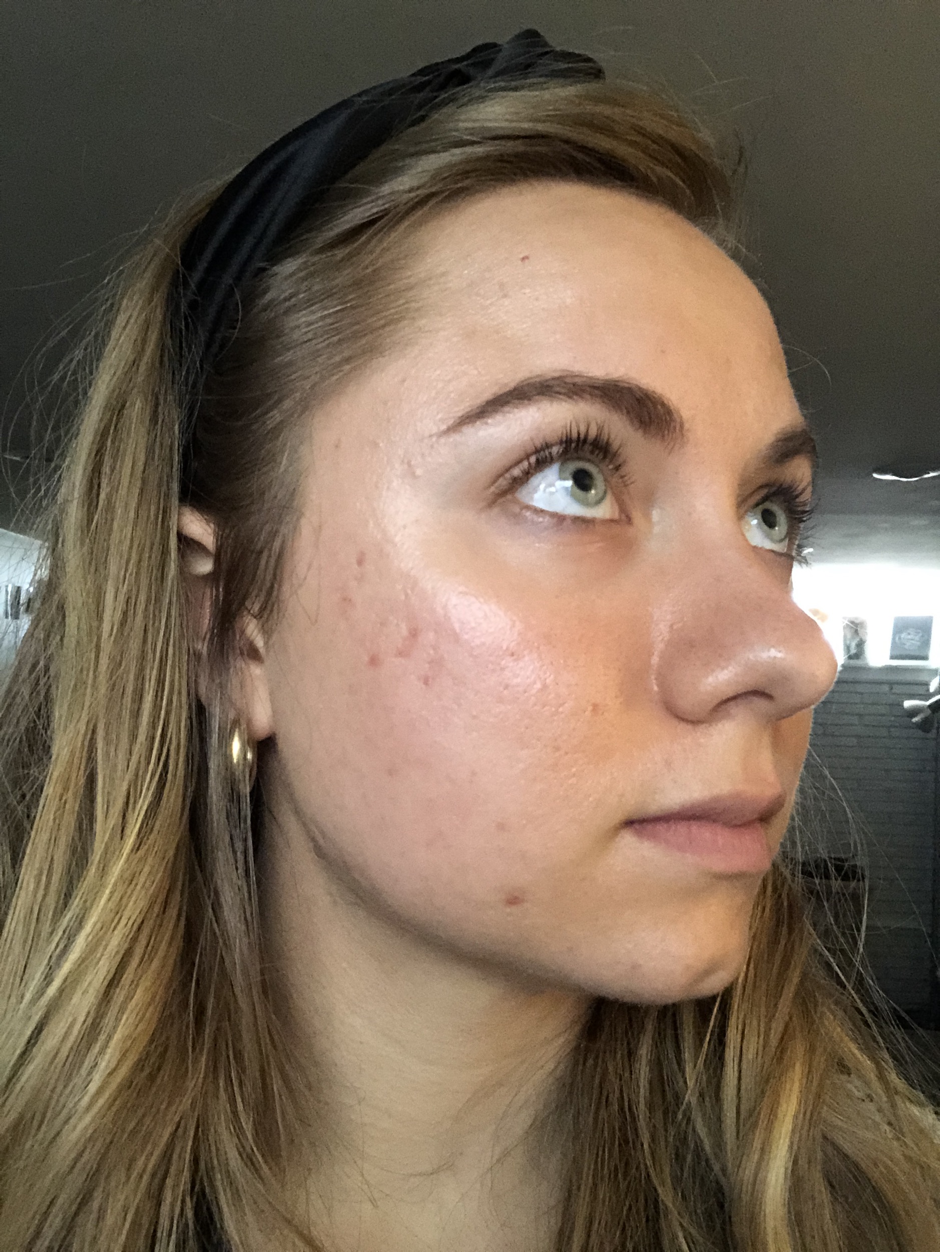 My Skin Story - Part 3