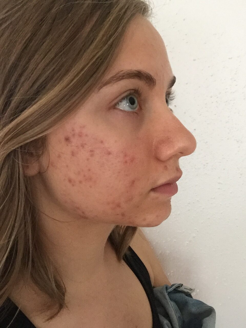 My Skin Story - Part 3